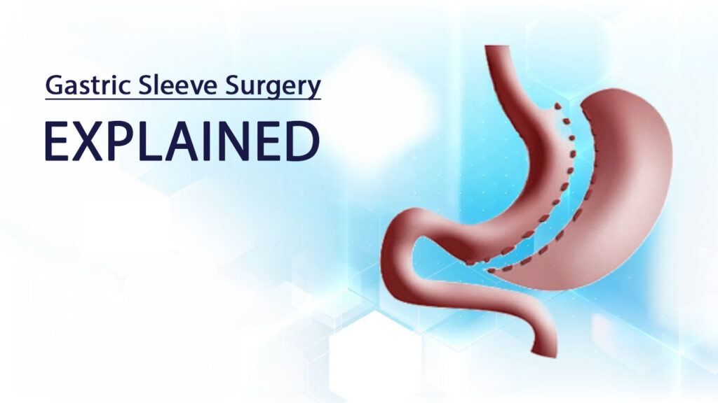 Gastric Sleeve Mexico Surgery | Bariatric Mexico